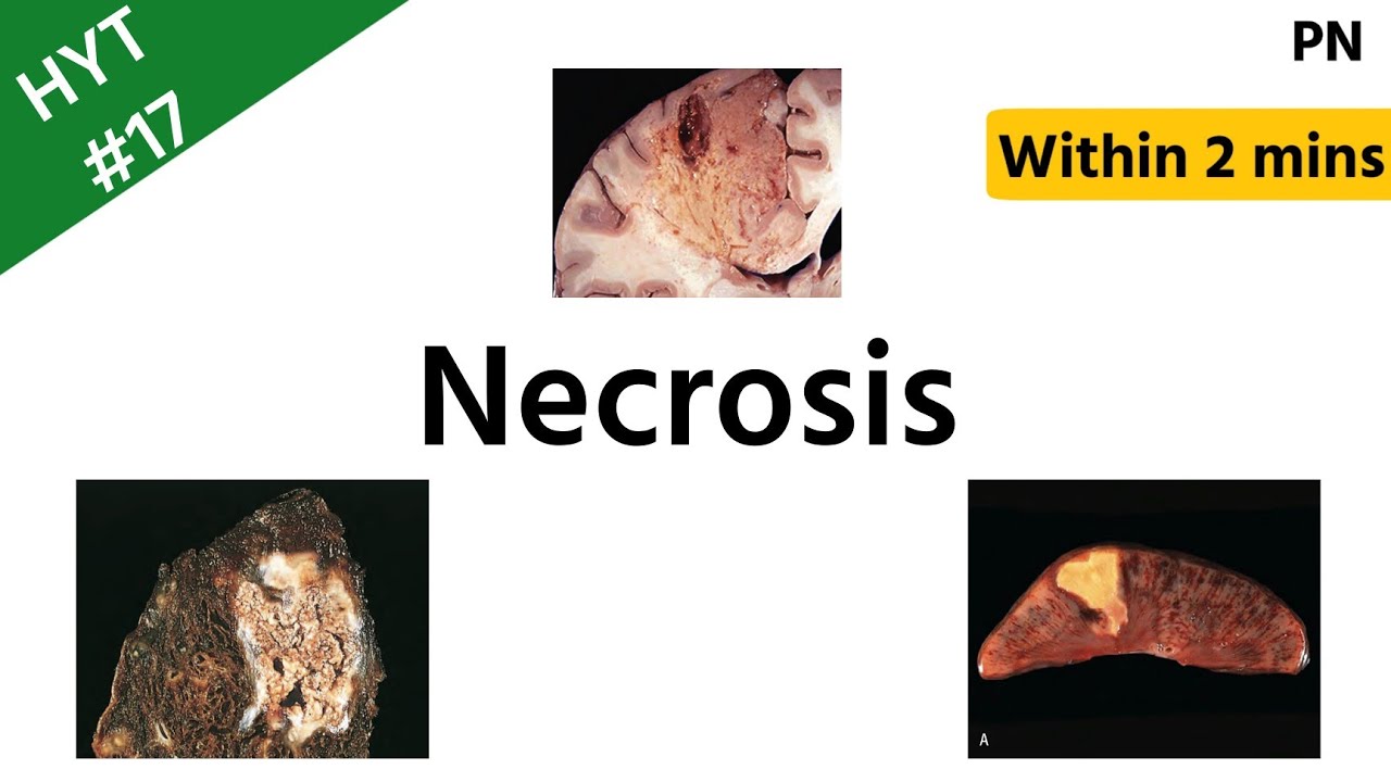 Necrosis | Types of Necrosis | Pathology | HYT #17 | NEETPG | INICET ...
