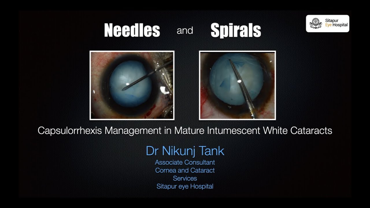Needles and Spirals - Management of Capsulorrhexis in Mature ...