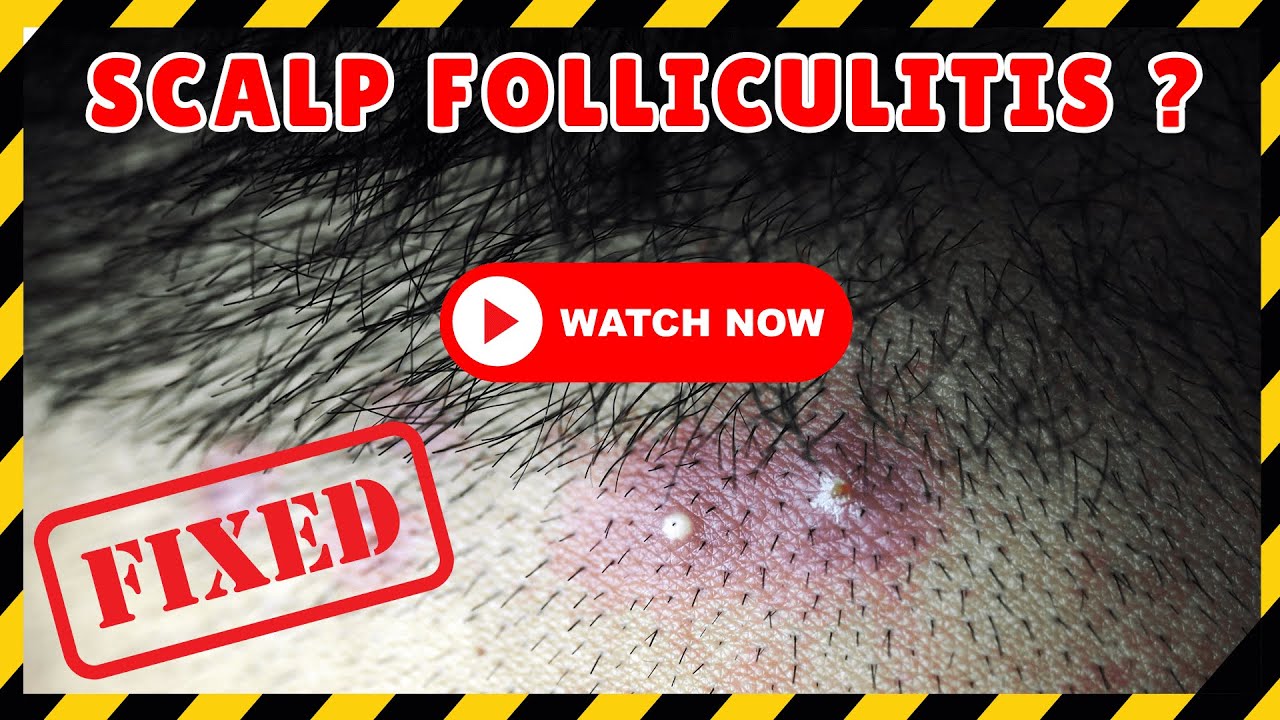 Scalp Folliculitis: Causes, Symptoms & Treatments for Hair Follicle ...