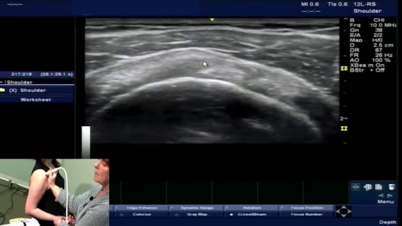 Ultrasound Exam of the Rotator Cuff - Hot Tip - YouTube
