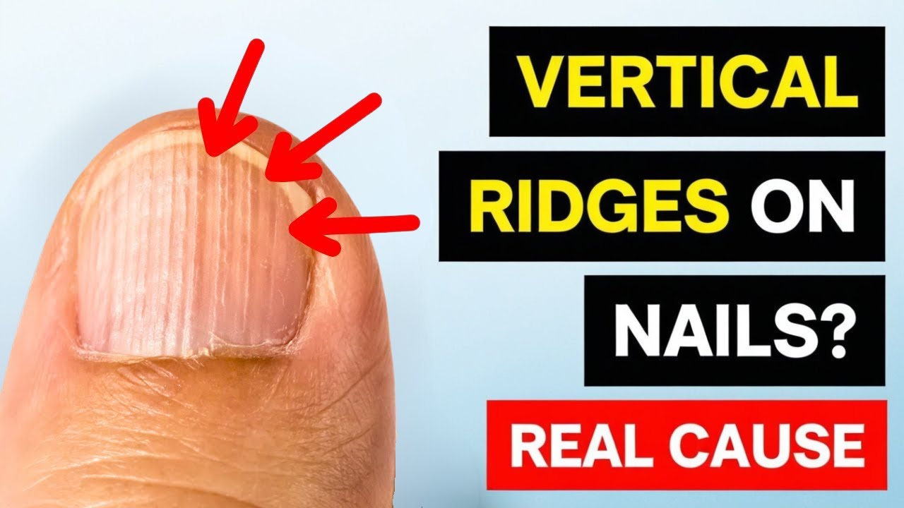 The REAL Causes of VERTICAL RIDGES On Your Nails - YouTube