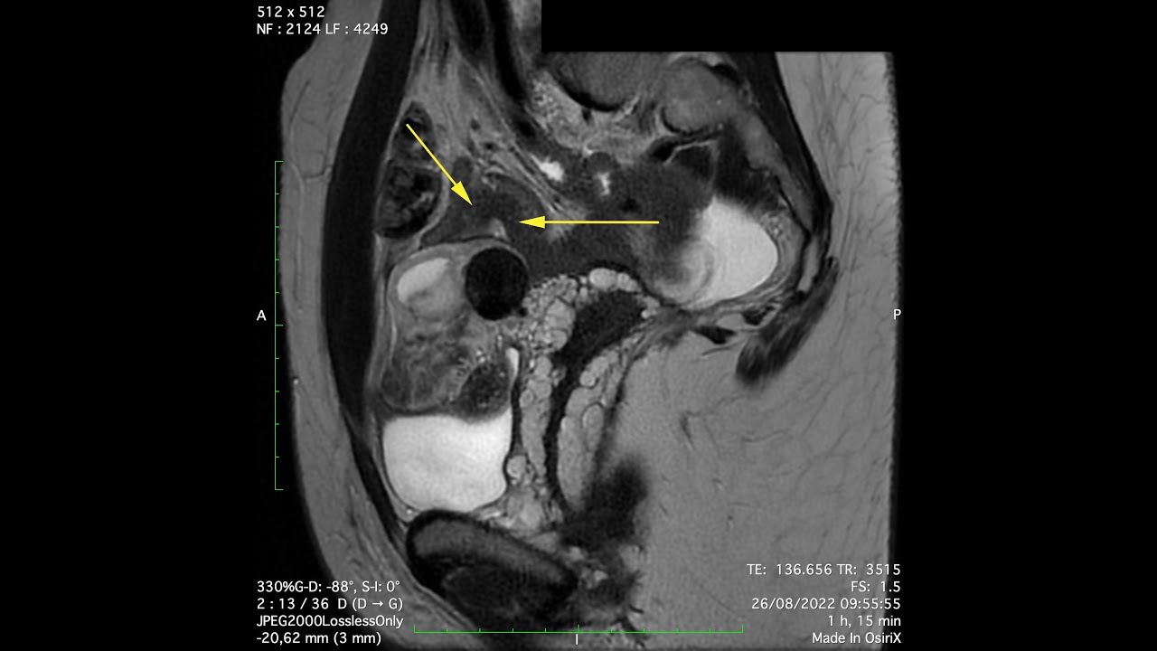 Excision of a large bladder nodule, small bowel nodule, endometrioma ...