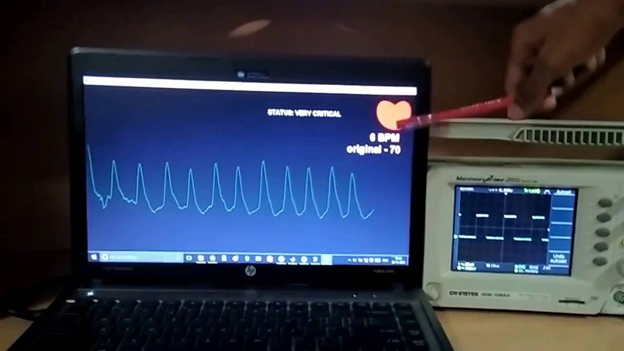 External Pacemaker using Arduino - YouTube