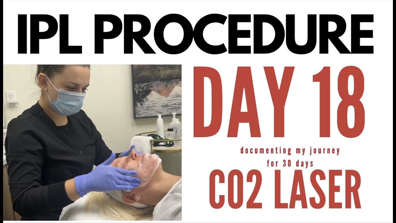 DAY 18 after C02 laser and IPL procedure (watch it!) TODAY. See my ...
