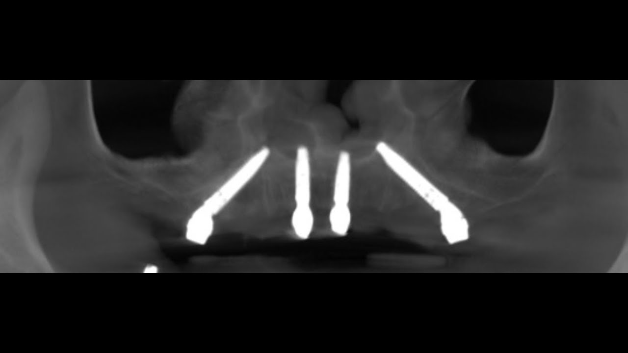 All on 4 with Sturman neodent dental implants (NEO ARCH) for upper jaw ...