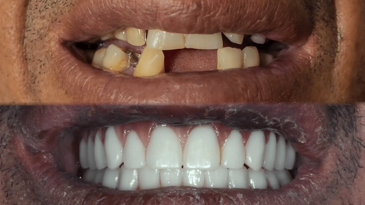 PROTESE PROTOCOLO - RESULTADO SURPREENDENTE (Antes e depois) - YouTube
