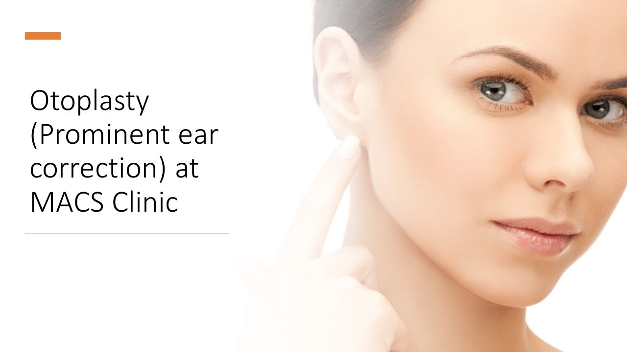 Bilateral Otoplasty (Prominent ear correction) procedure performed ...