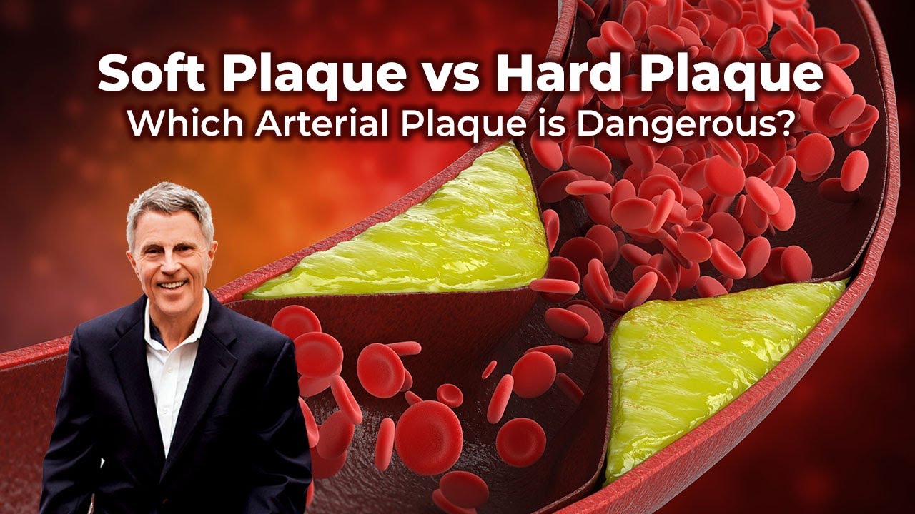 Soft Plaque vs Hard Plaque - Which Arterial Plaque is Dangerous? - YouTube