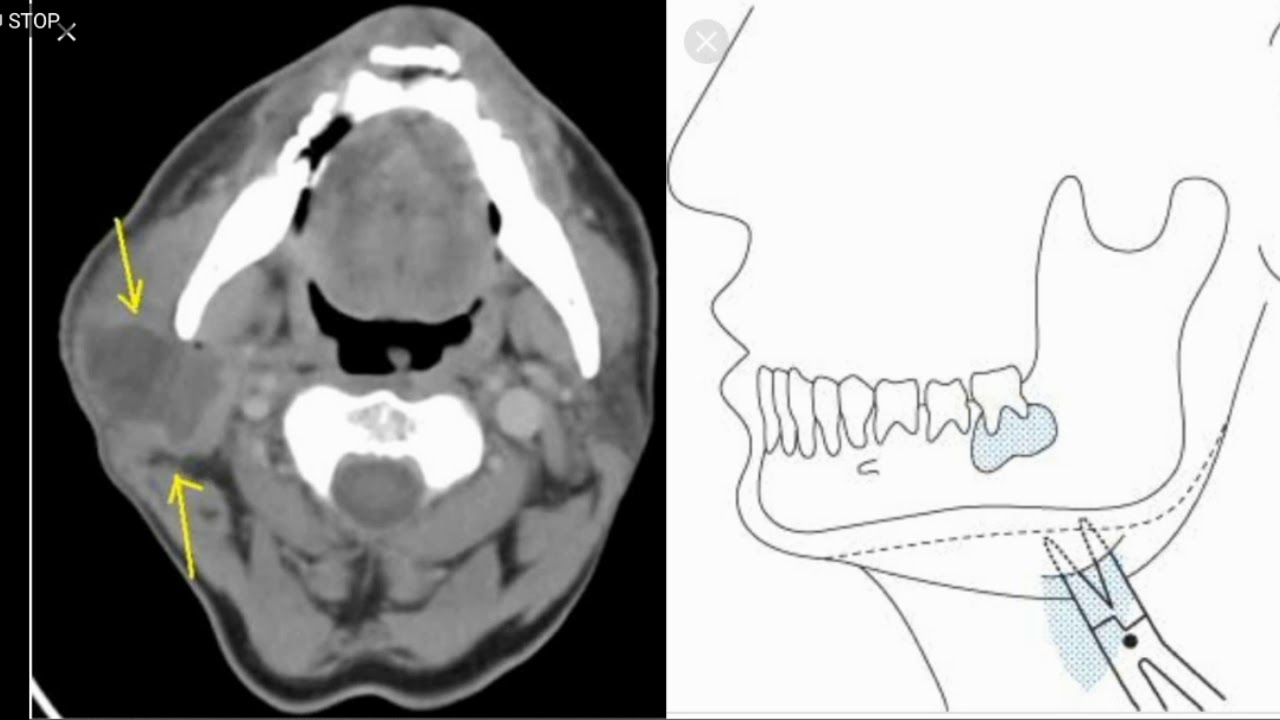 Clinical anatomy of parotid gland | in just 2 minutes | #anatomy - YouTube