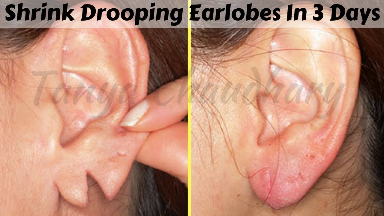 Shrink Drooping Earlobes In Just 3 Days Naturally At Home | 100% ...