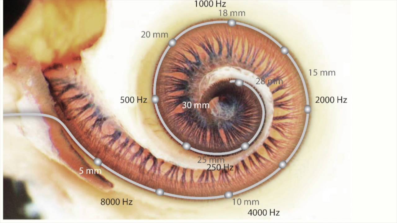 What Are Cochlear Implants - YouTube