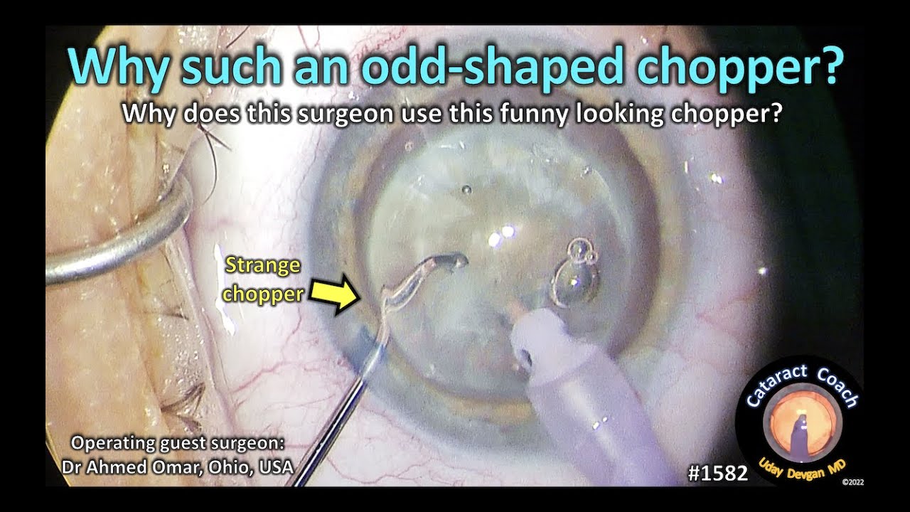 CataractCoach 1582: Quiz: why such an odd-shaped chopper? - YouTube