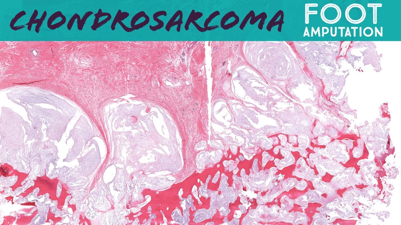 Chondrosarcoma of the foot (RARE SITE!) - amputation specimen (bone ...