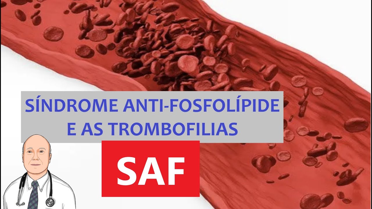O que é síndrome anti-fosfolípide (SAF) e o que é importante sobre ...