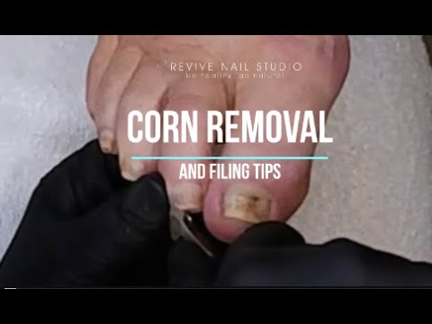Impacted Nail Cleaning + Corn Removal! - YouTube