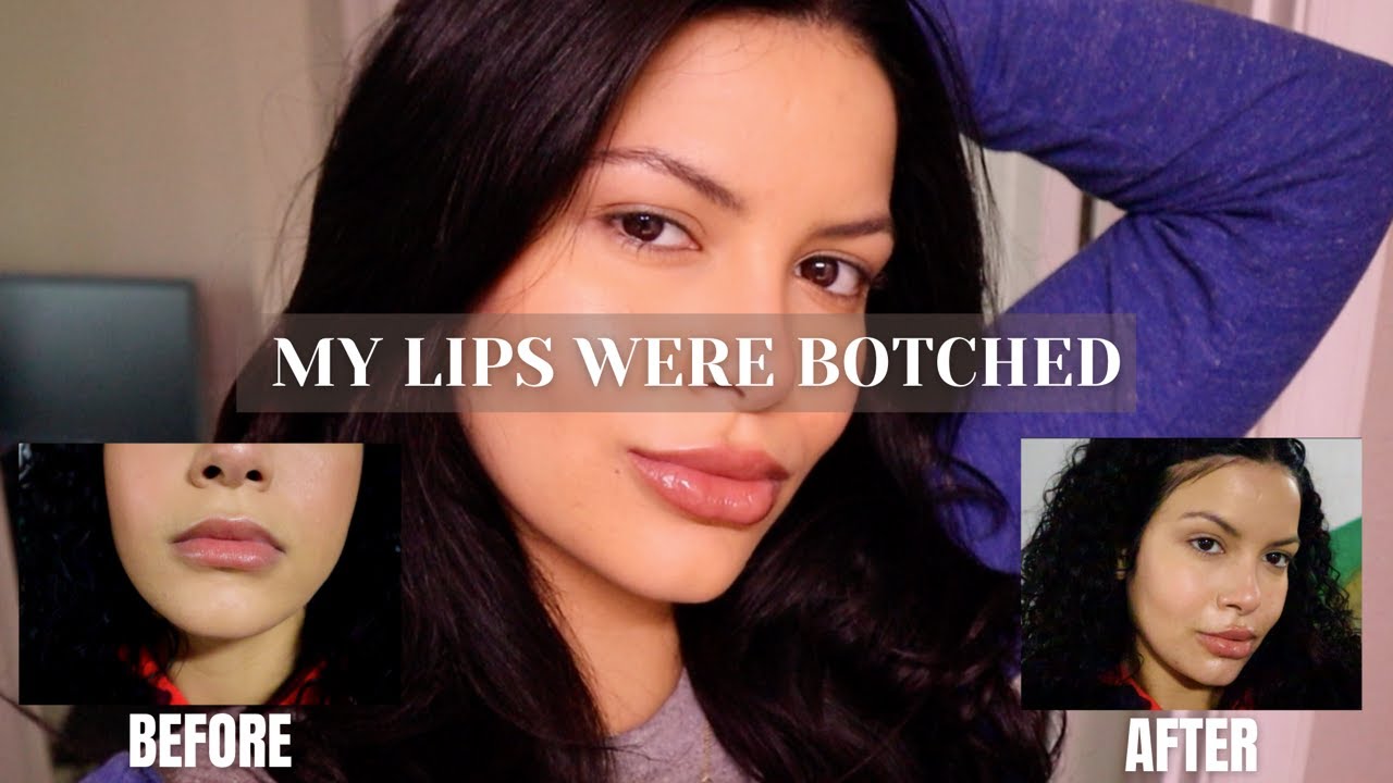 MY LIPS WERE BOTCHED | STORY TIME + WHAT MY LIPS LOOK LIKE NOW - YouTube