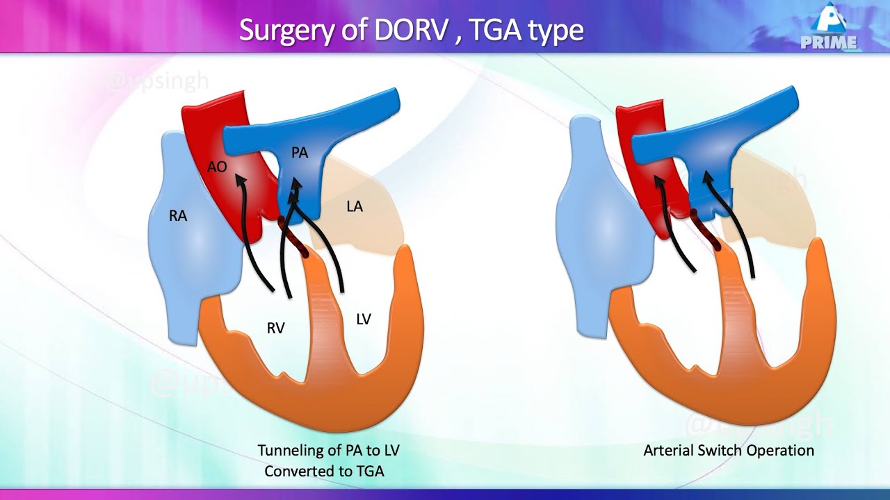 DORV: From diagnostic challenges to surgical solutions: A Journey ...