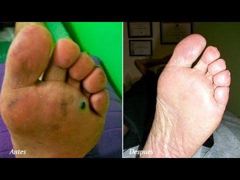 Cómo preparar un remedio natural para las úlceras del pie diabético ...