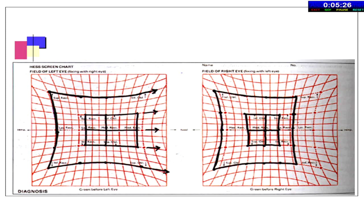 AIOC2020 GP043 T5 Dr Meenakshi Swaminathan Hess and Diplopia charting ...