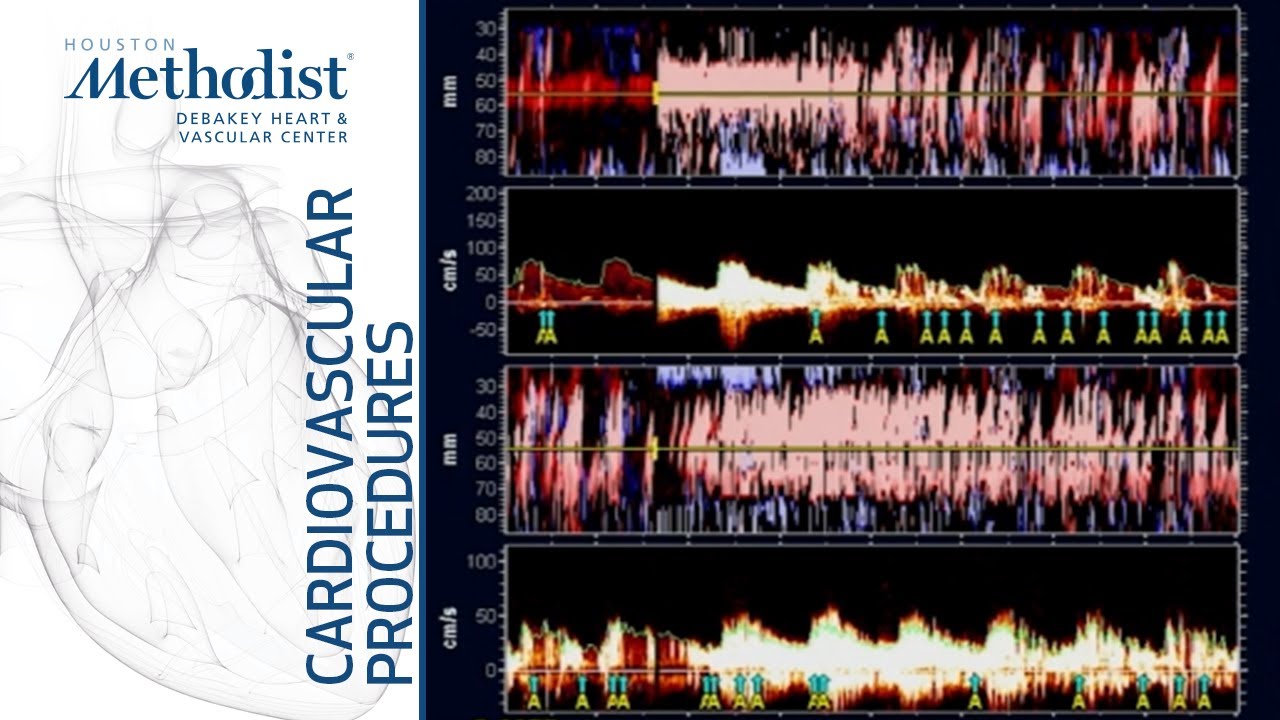 TCD for TEVAR & Endo Procedures Involving Ascending Aorta & Aortic Arch ...