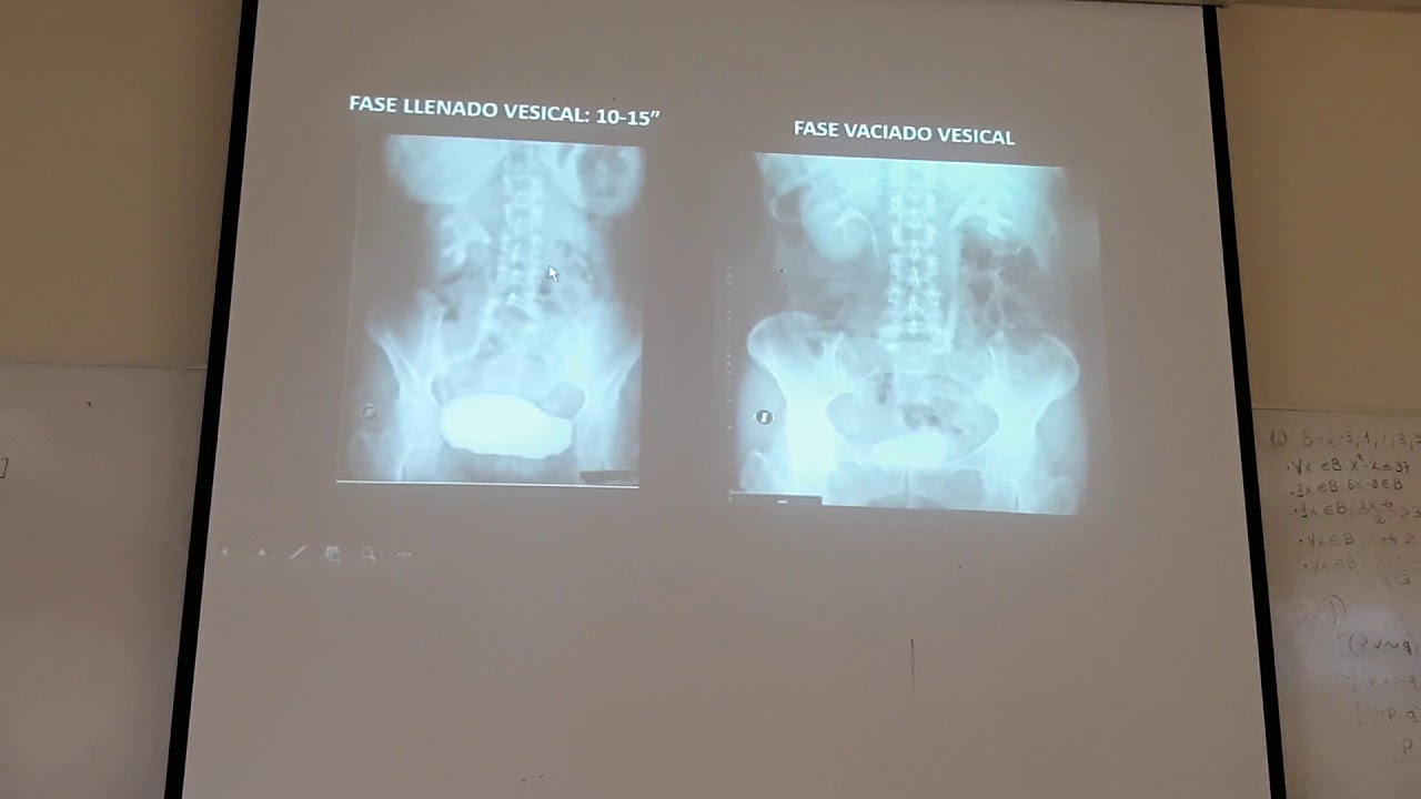 DPI II (Pràctico) - Urografía, urotem y urolitiasis (1era parte) - YouTube