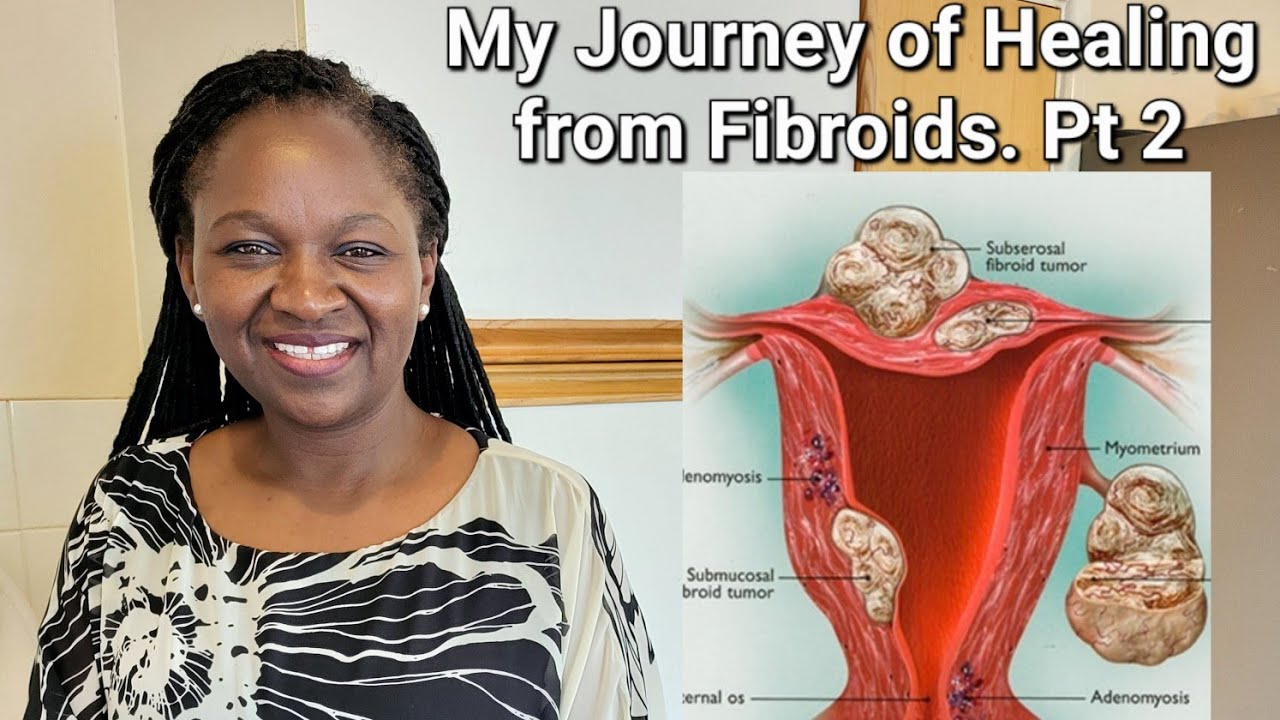 My Journey of Healing from Fibroids. Pt 2. "True causes of Fibroids ...