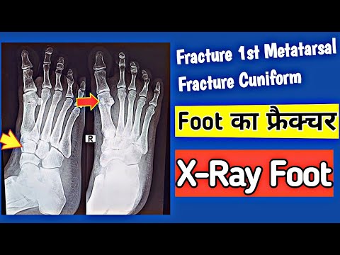 Fracture Cuneiform Tarsal bone || Fracture 1St Metatarsal || X-Ray Foot ...