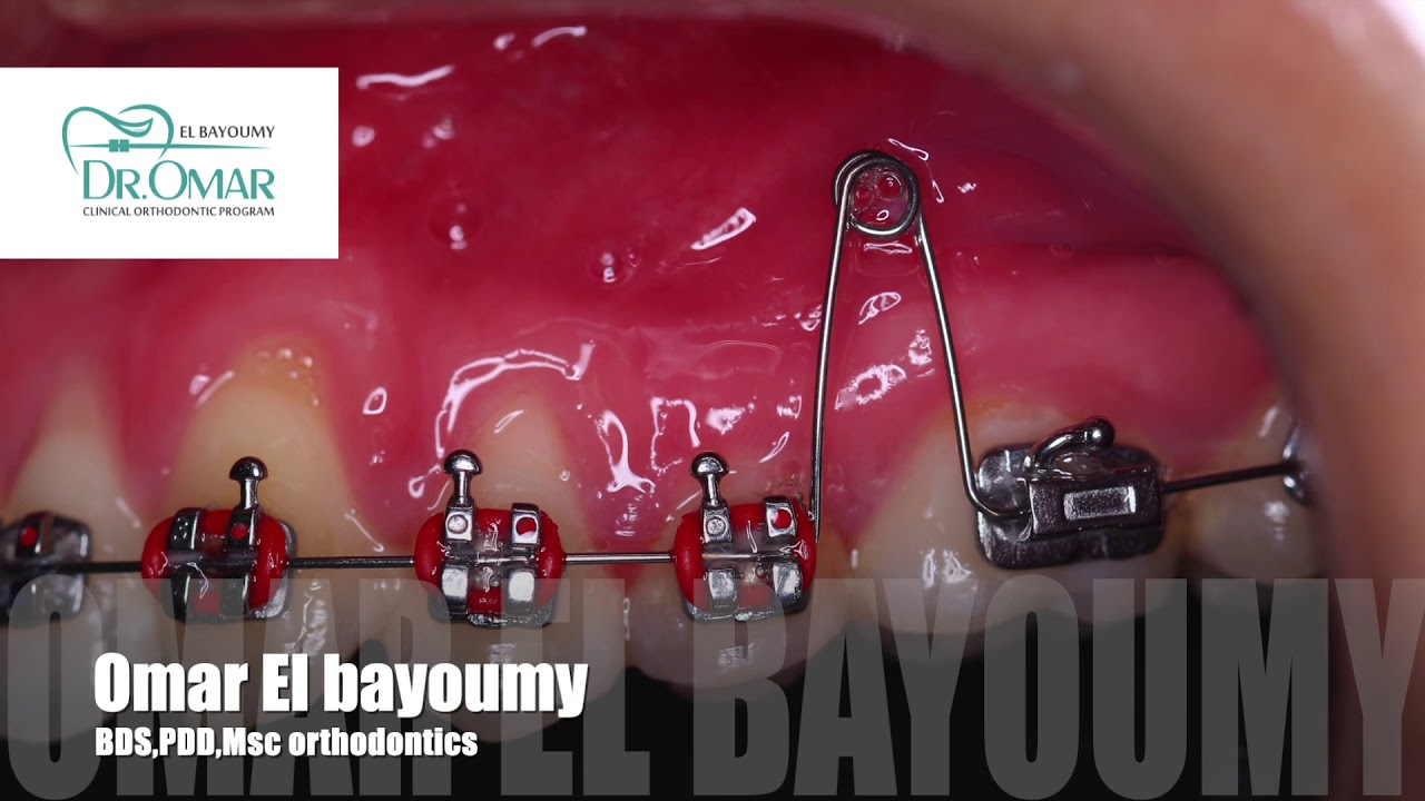 Mini implant insertion with a surgical guide by wire bending ...