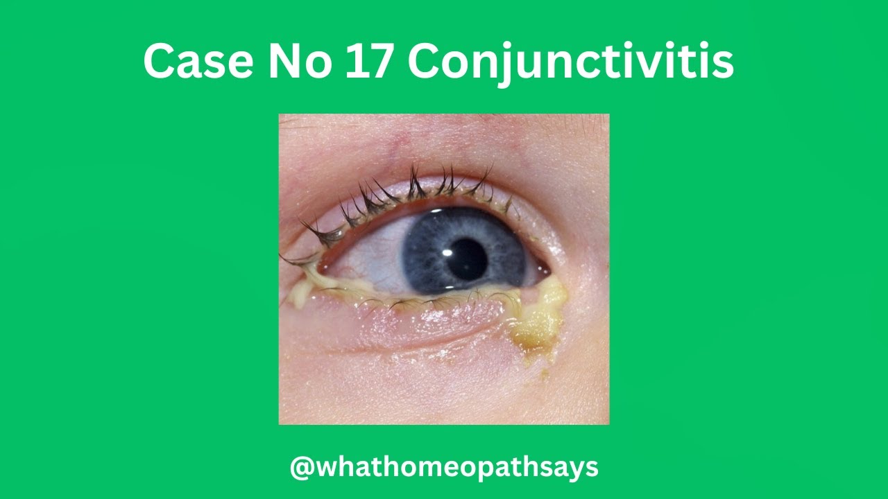 Case 17 Conjunctivitis - YouTube