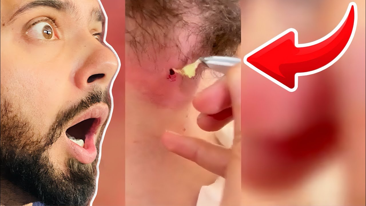 Popping huge blackheads and Giant Pimples- Best Pimple Popping Videos ...