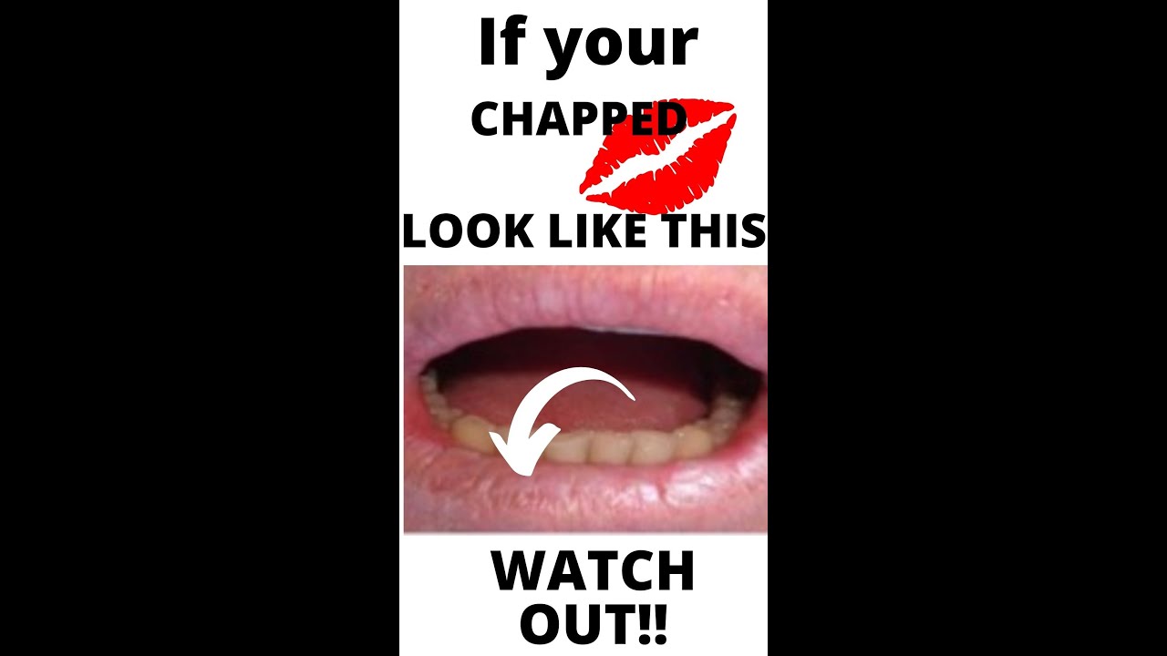 If your chapped lips looks like this watch out! - YouTube