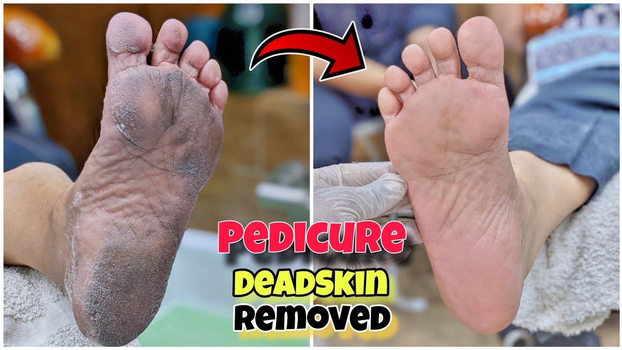 Crusty Pedicure (ASMR! Tutorial) and professionally // callus & cracks ...