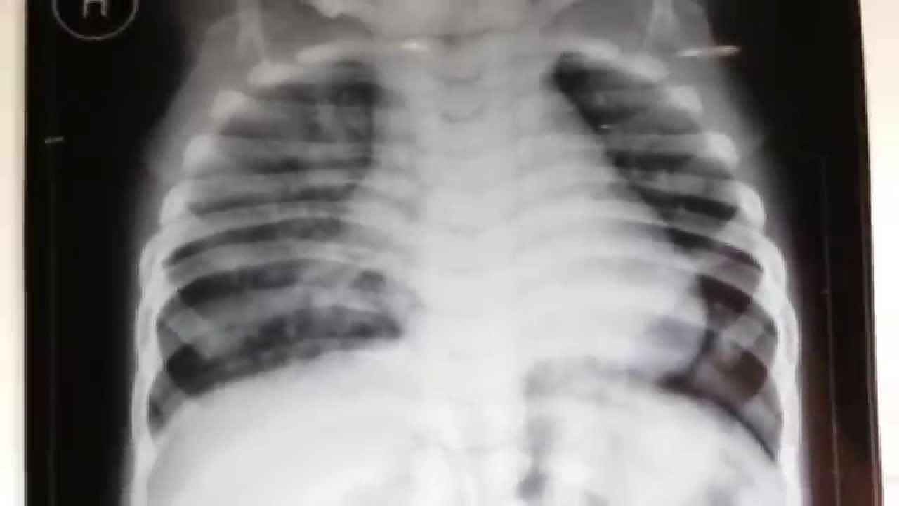 Chest X ray notice pulmonary artery hypertension - YouTube