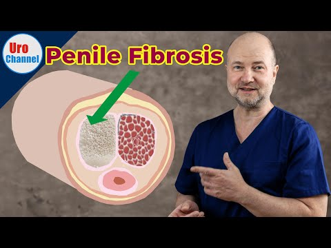 A frequently overlooked reason for Erectile Dysfunction | UroChannel