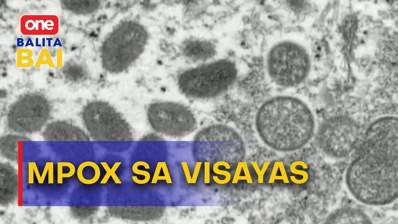 Mga otoridad, nakabantay din sa mpox cases sab sa Visayas ug Mindanao ...