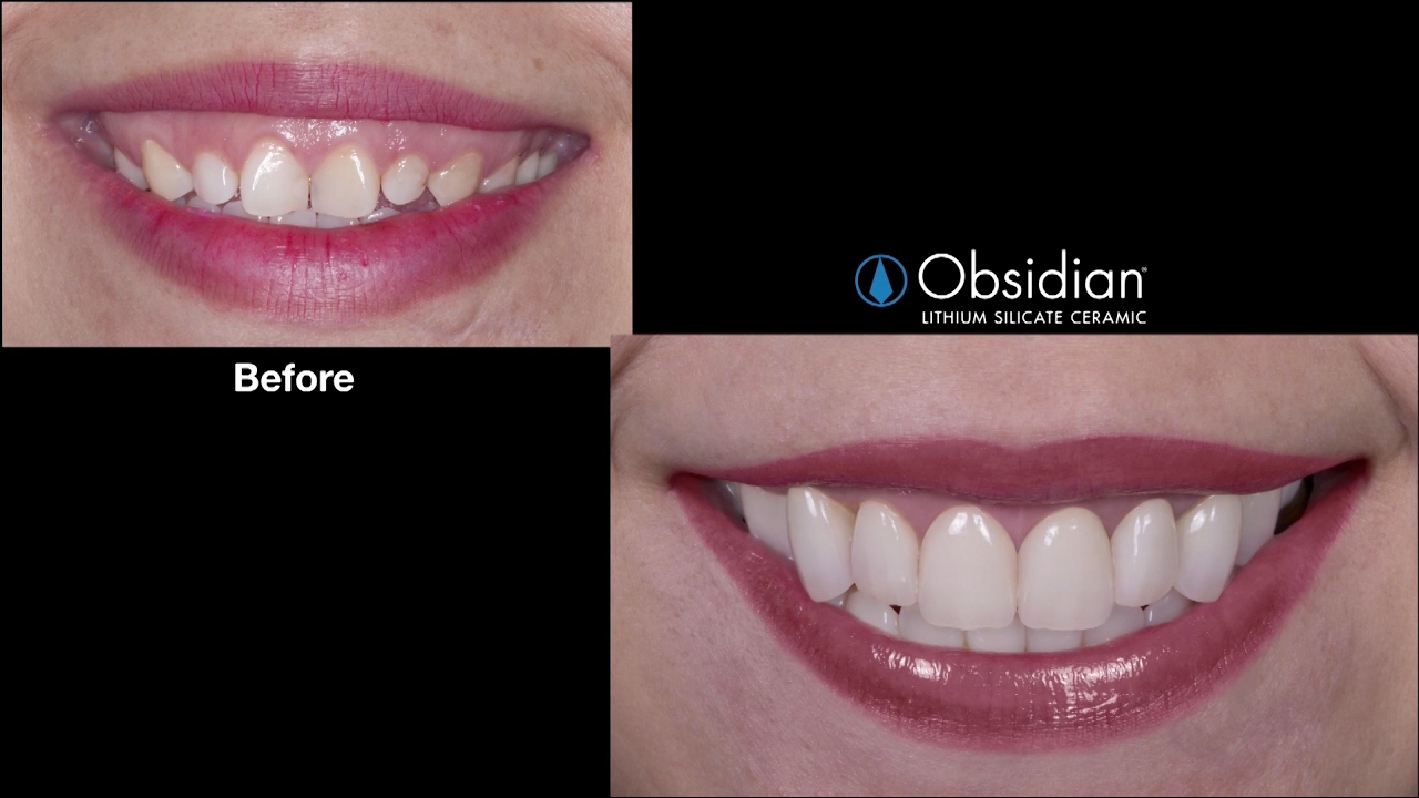 Case of the Week: A Case With Obsidian® Veneers - YouTube
