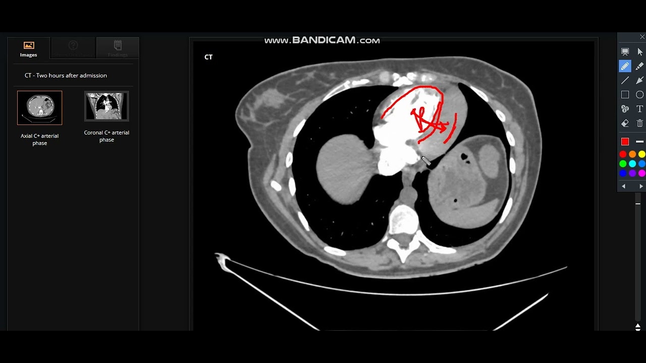 Case #13: Extensive pulmonary emboli with right heart strain - YouTube