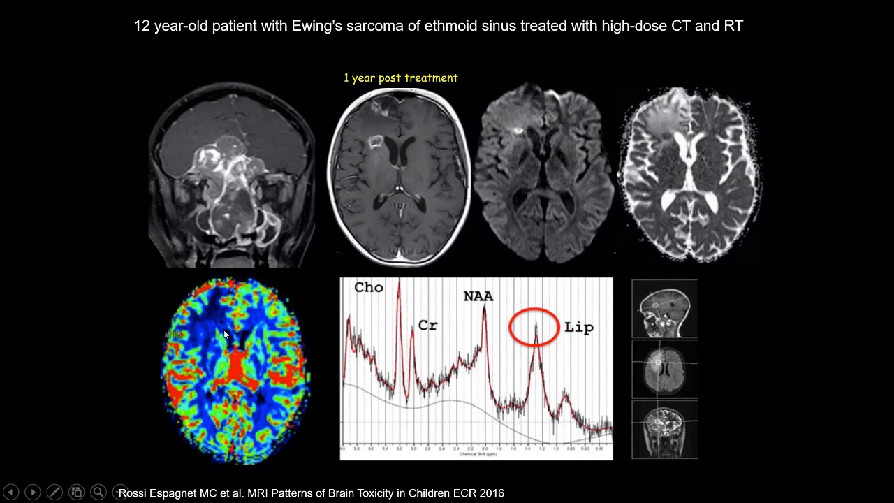 International Cancer Imaging Society Oct 17. Imaging of radiation ...