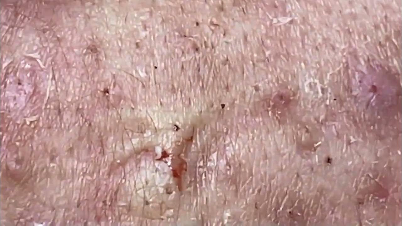 Acne Blackheads Whiteheads Removal Blackhead Extraction Enilsa Brown Youtube