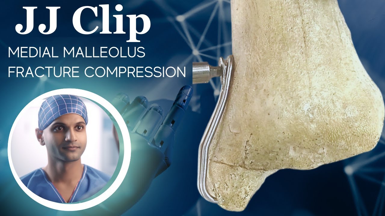 JJ Clip Medial Malleolus Fracture compression - YouTube
