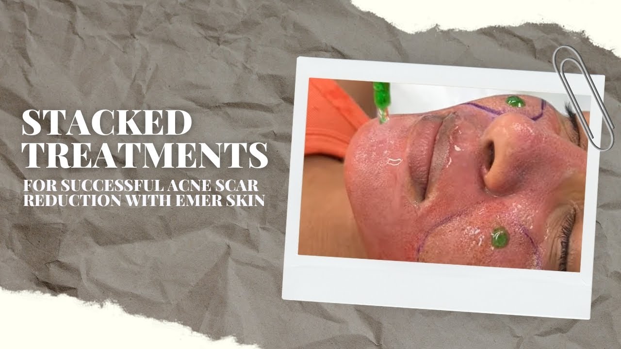 STACKED TREATMENTS FOR SUCCESSFUL ACNE SCAR REDUCTION WITH EMER SKIN ...