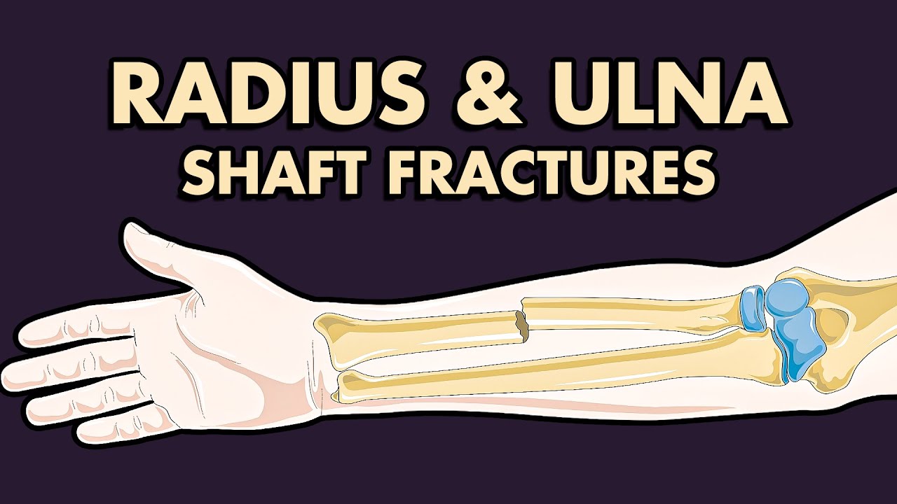 Radius and Ulna Shaft Fractures: Treatment, Complications, Anatomy and ...