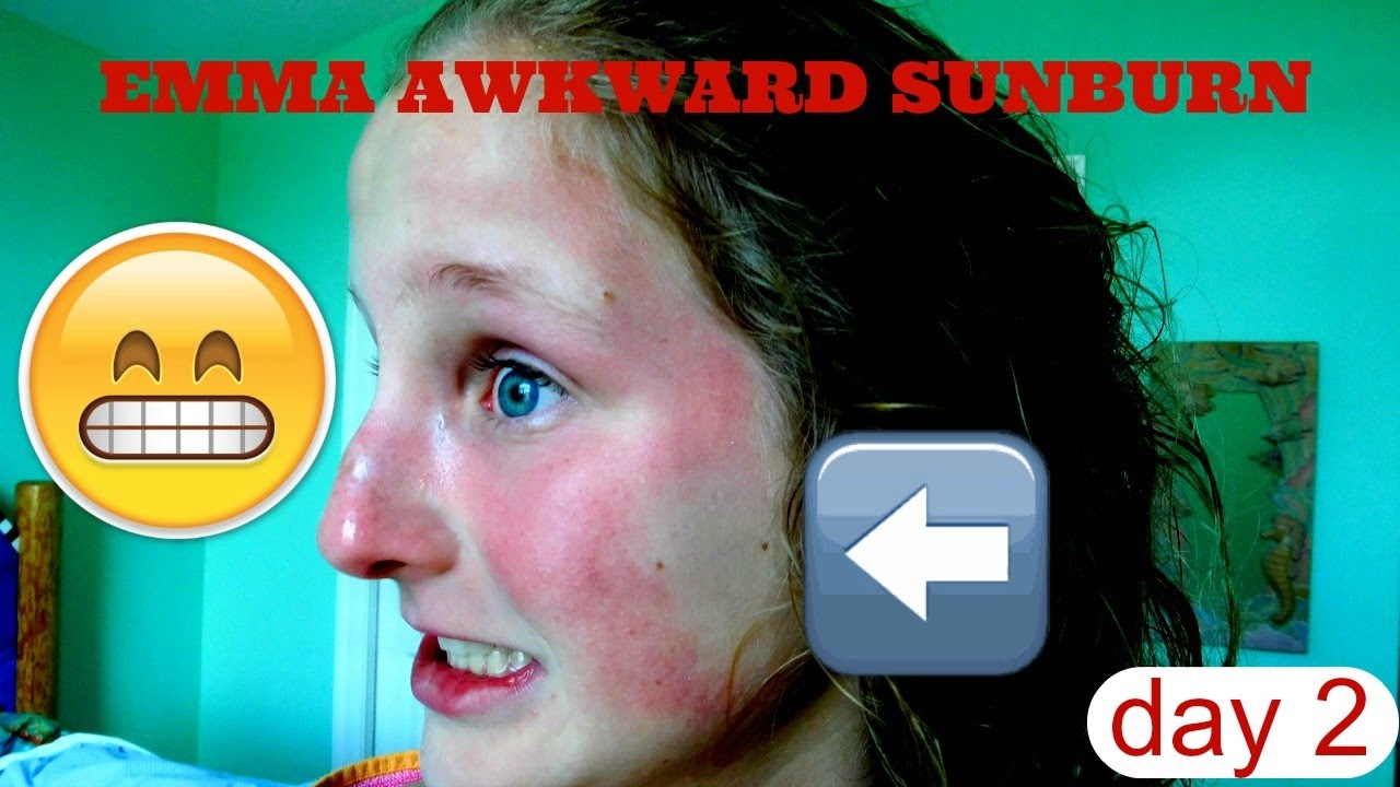 EMMA GETS A AWKWARD SUNBURN |spring break day 2 - YouTube