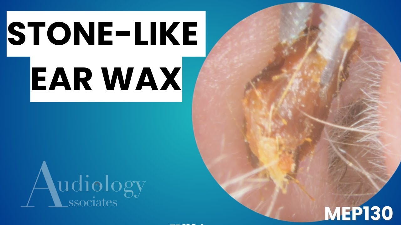 Extreme Ear Wax Removal Compilation | Rock Solid Plugs Extracted ...