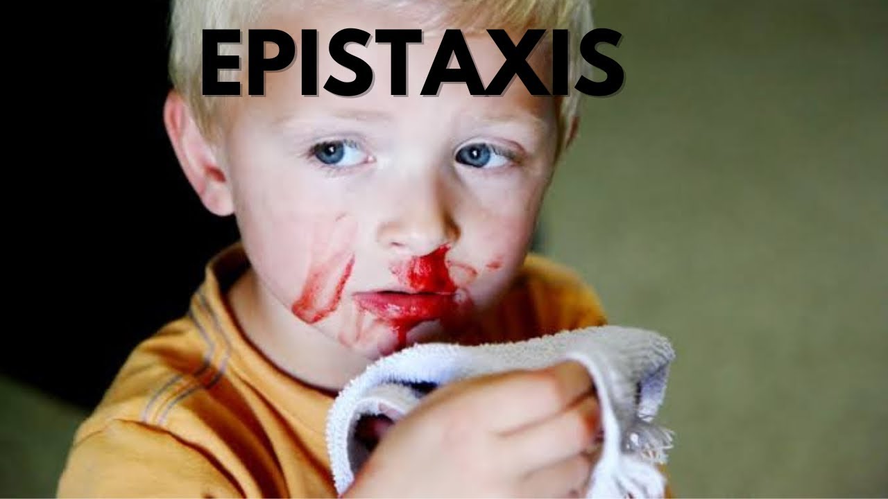 Epistaxis- Definition, related anatomy, causes - YouTube