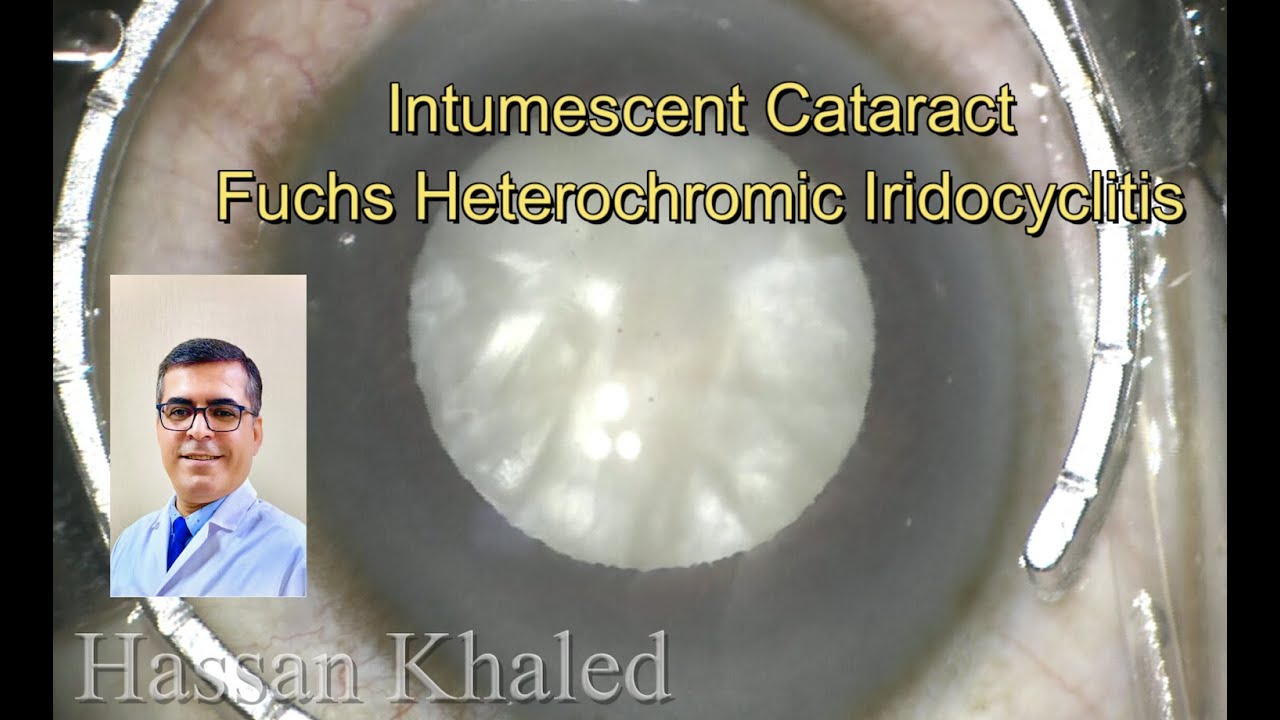 Phacoemulsification of Intumescent Cataract & Fuchs heterochromic ...