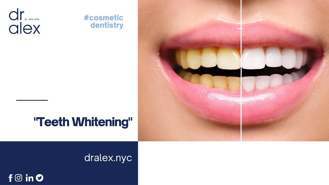 Teeth Whitening - Dr. Alex Rubinov - Cosmetic Dentist in NYC - YouTube