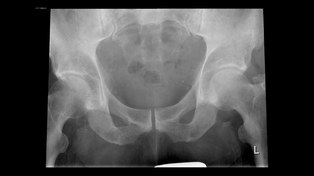 Pelvic Radiograph part 3 - YouTube