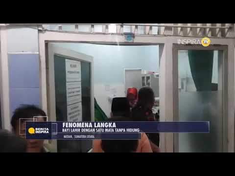 fenomena langka seorang ibu melahirkan anak bermata satu