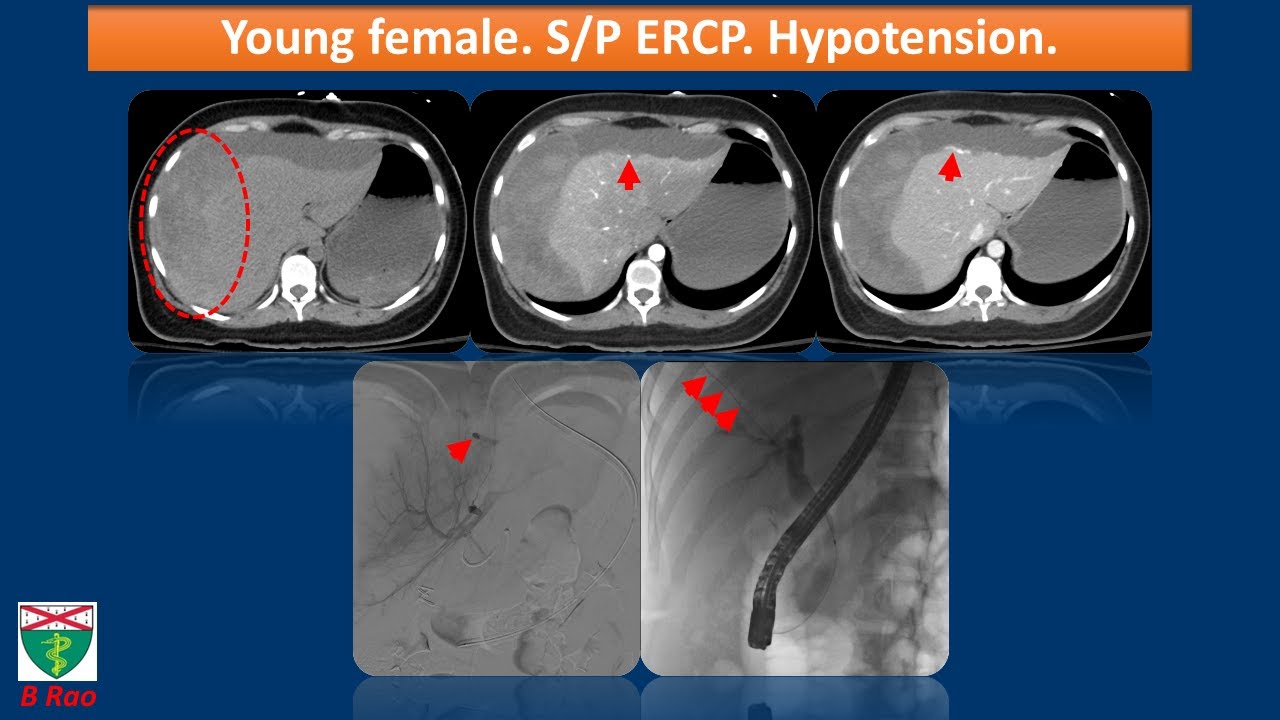 Liver Perforation following ERCP Video - YouTube